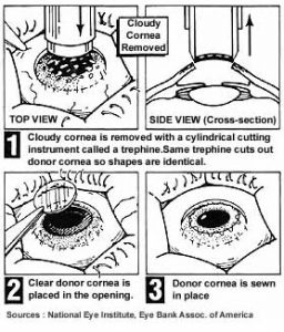 Stages Of Corneal Transplant Surgery | The Eye-Bank for Sight Restoration